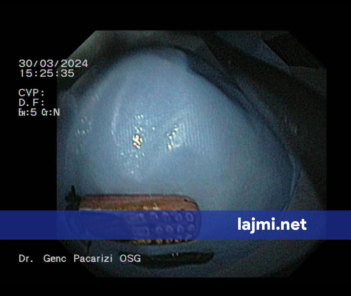 Pacientit në Malishevë i hiqet telefoni nga lukthi – Lajmi.net